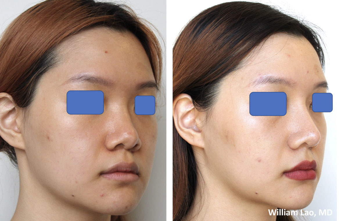Asian Rhinoplasty NYC | Asian Nose Job New York City | William Lao, MD