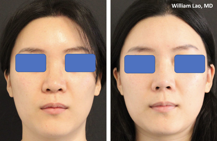 Asian Rhinoplasty NYC | Asian Nose Job New York City | William Lao, MD
