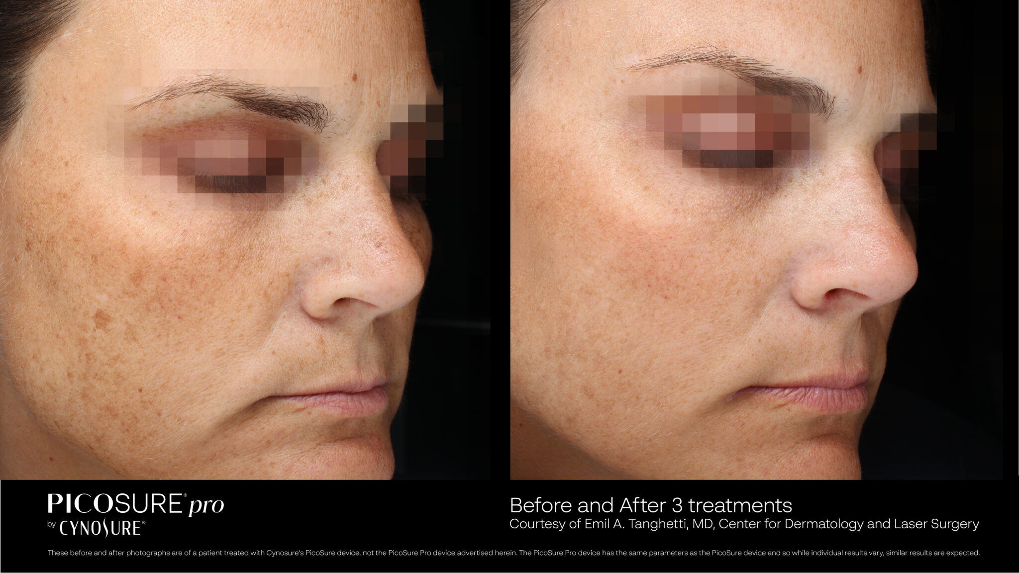 Picosure Pro Laser In NYC | William Lao, MD